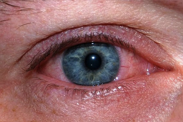 Enfermedades oculares por exposición al sol | Luzclinic 👁